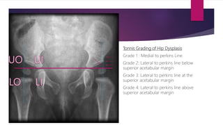 Developmental dysplasia of hip imaging | PPTX