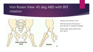 Developmental dysplasia of hip imaging | PPTX