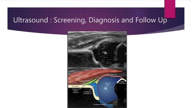 Developmental dysplasia of hip imaging | PPTX