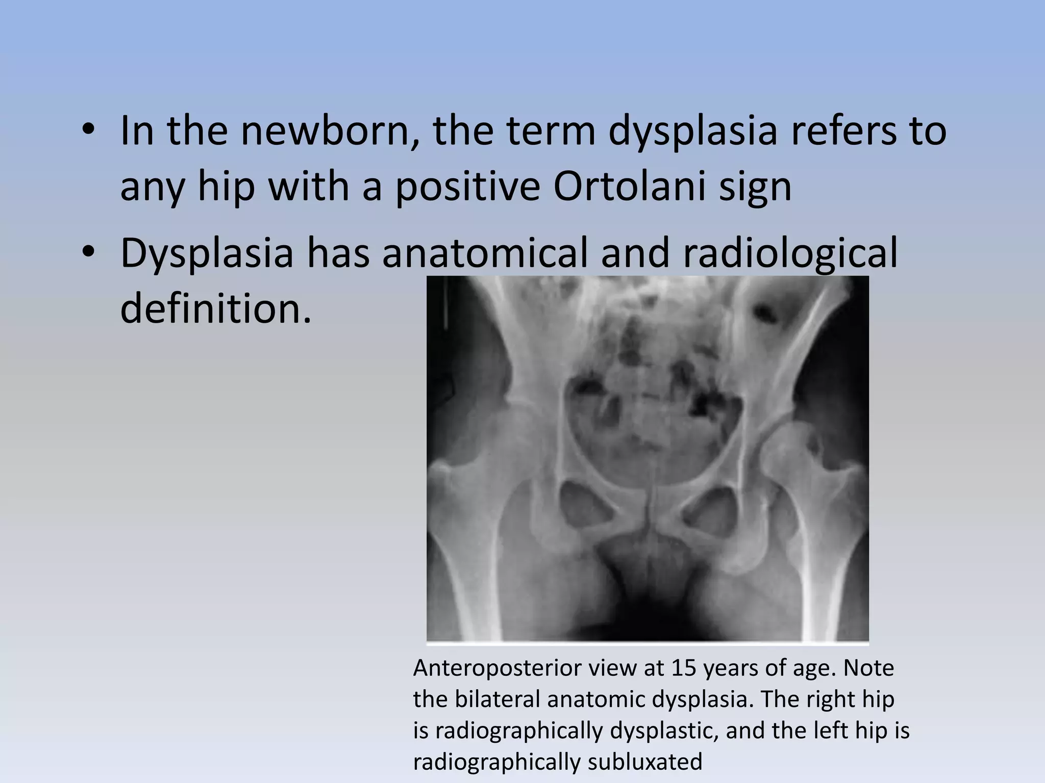 Developmental dysplasia of hip 1 | PPTX