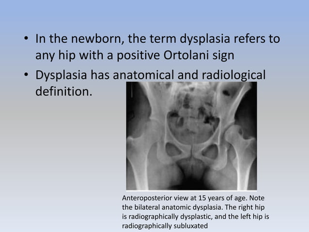 Developmental dysplasia of hip 1 | PPT