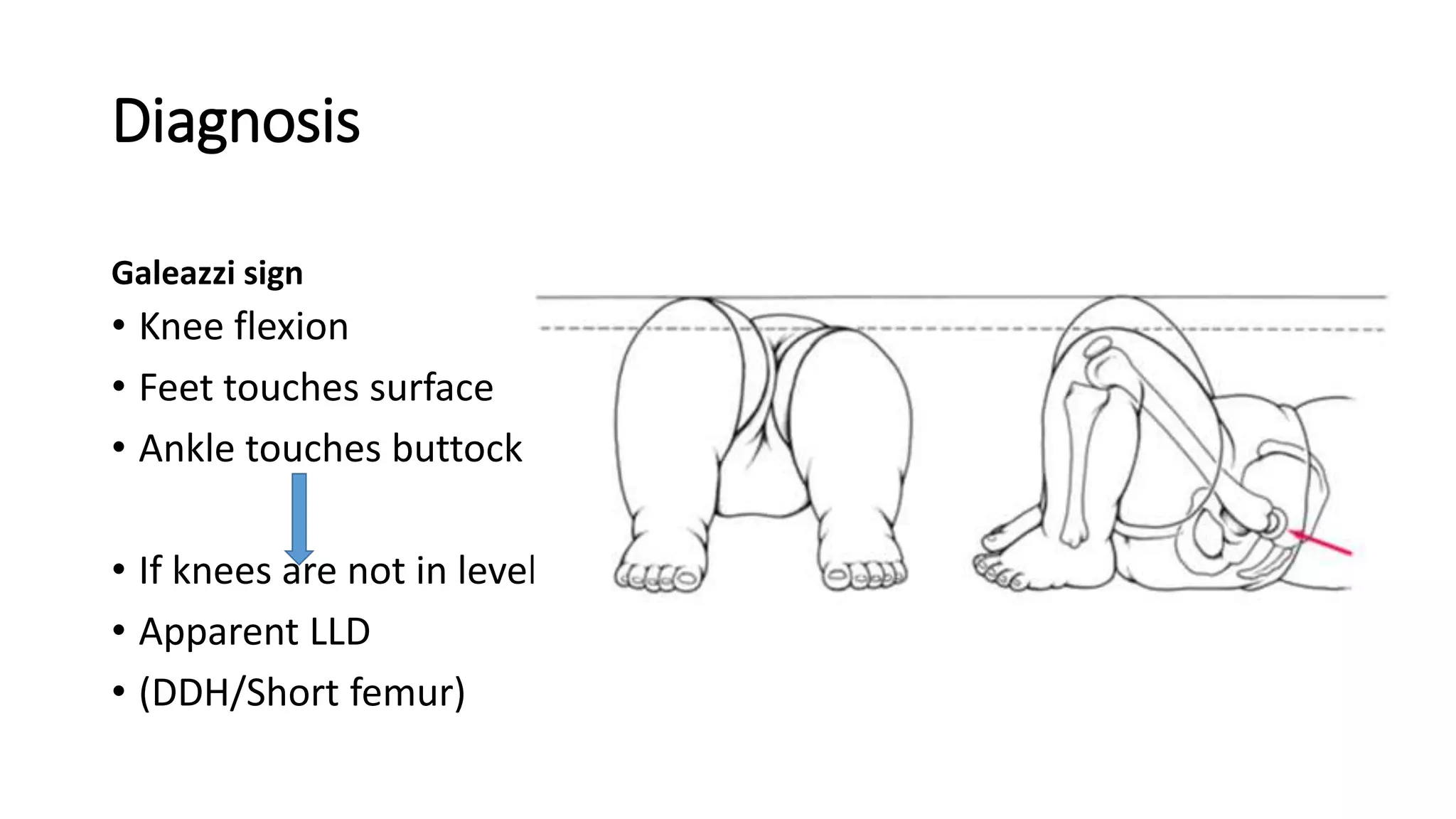 Developmental Dysplasia of Hip final.pptx