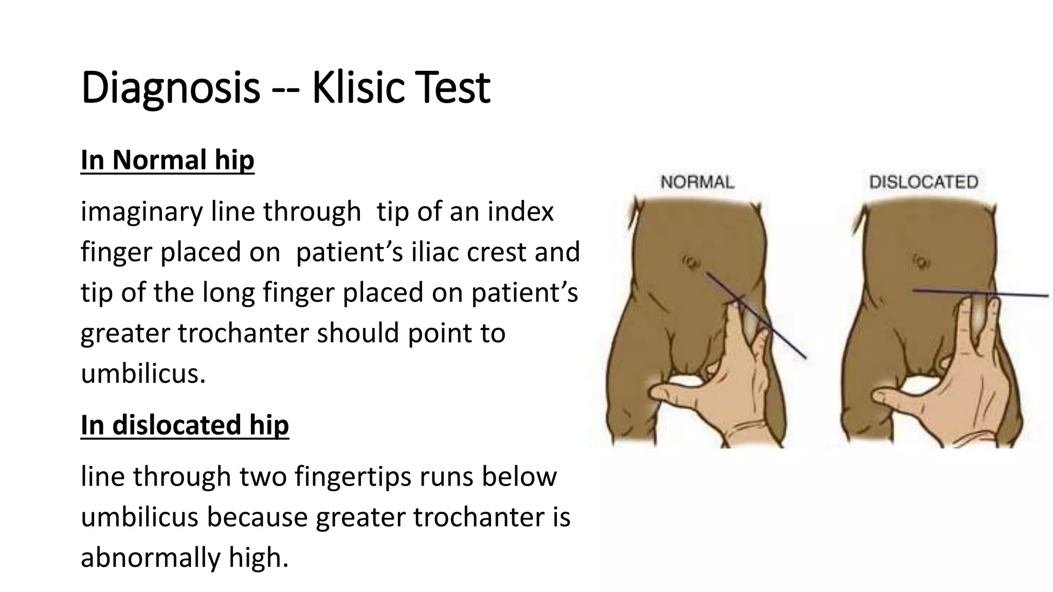 Developmental Dysplasia of Hip final.pptx | Pregnancy | Reproductive Health