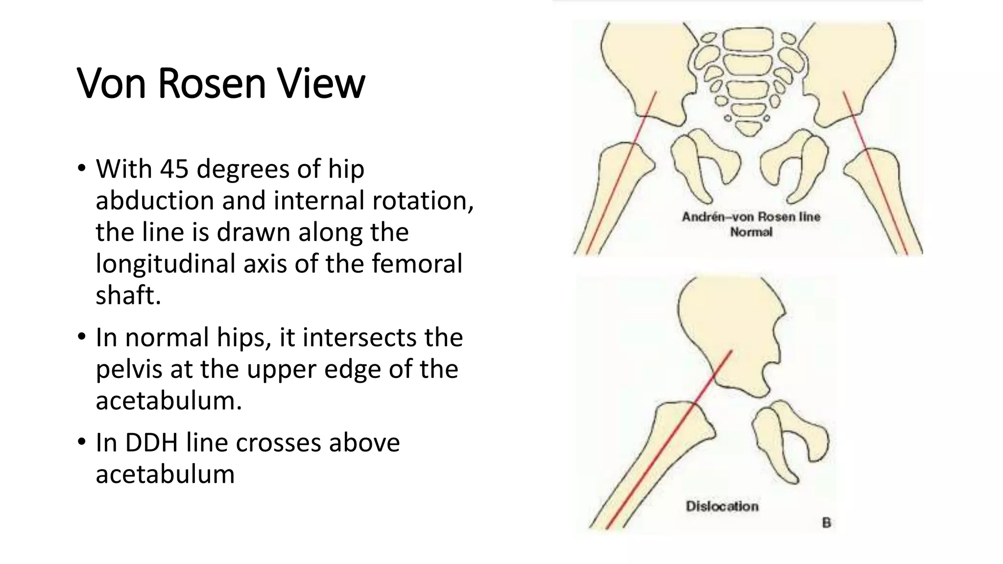 Developmental Dysplasia of Hip final.pptx | Pregnancy | Reproductive Health