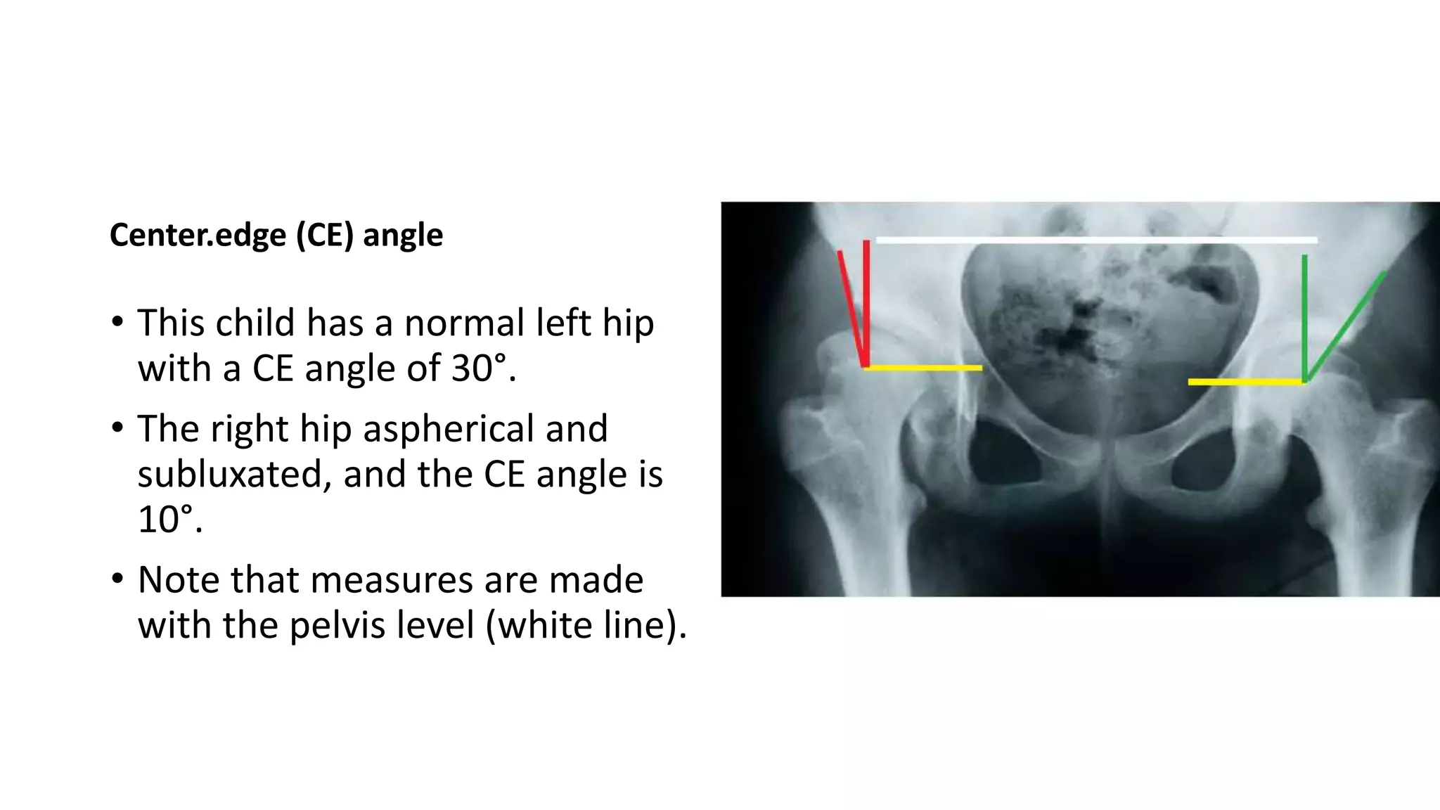 Developmental Dysplasia of Hip final.pptx