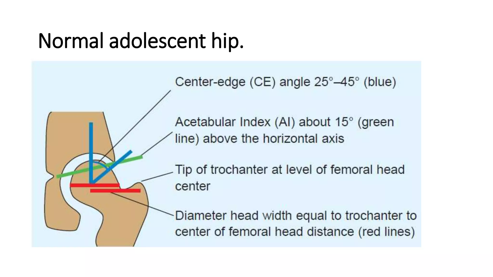 Developmental Dysplasia of Hip final.pptx