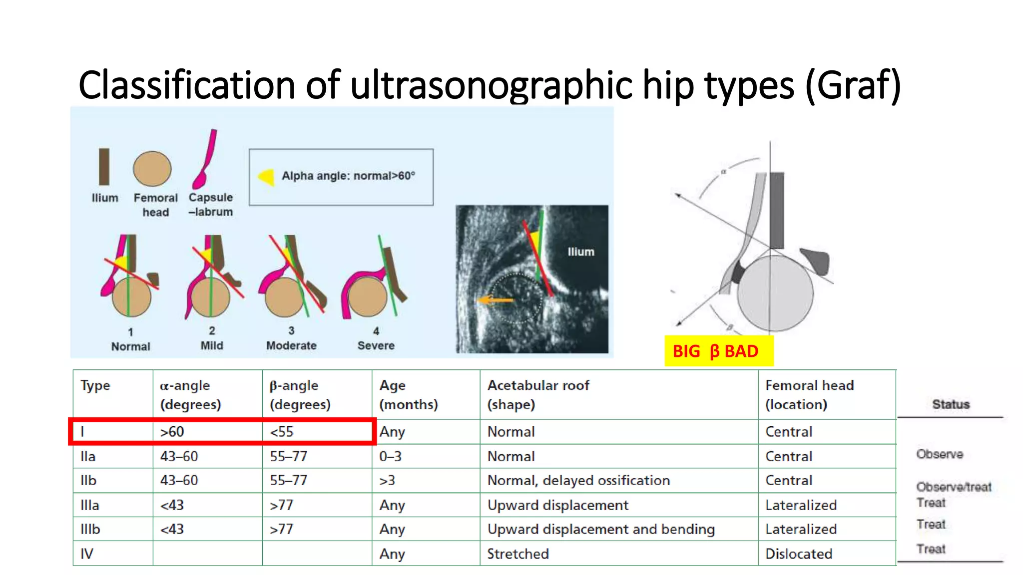 Developmental Dysplasia of Hip final.pptx