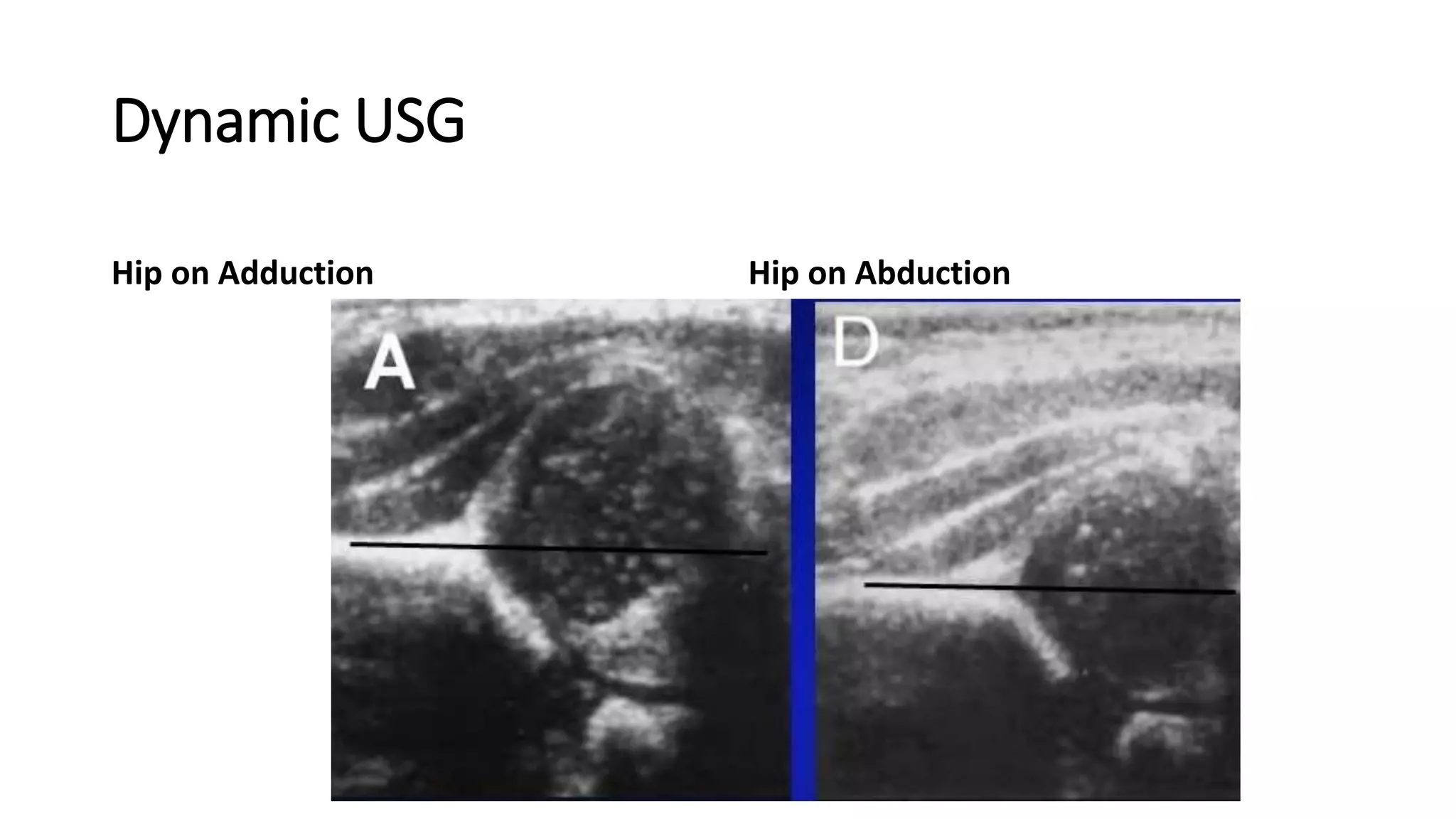 Developmental Dysplasia of Hip final.pptx