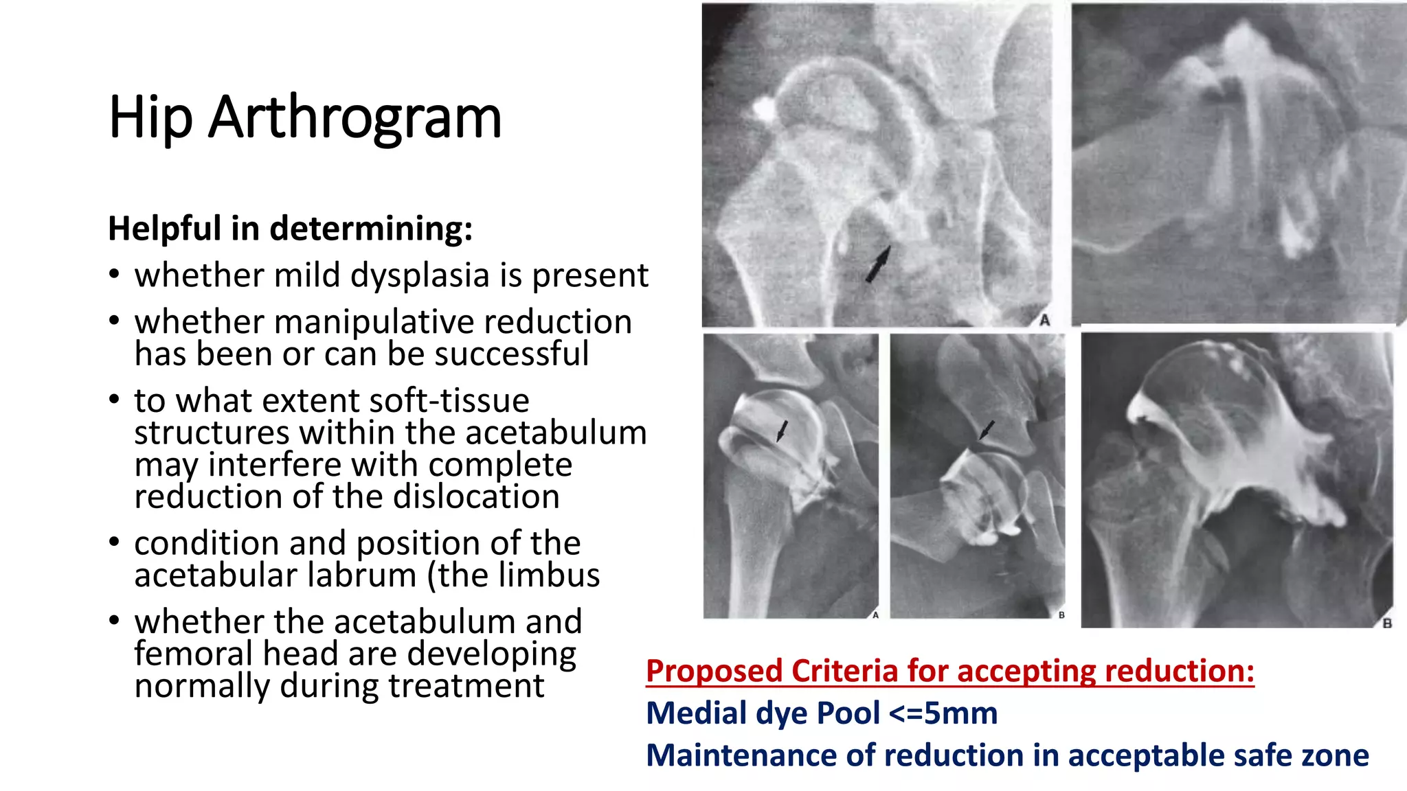 Developmental Dysplasia of Hip final.pptx