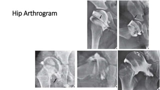 Developmental Dysplasia of Hip final.pptx