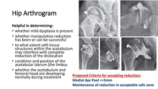 Developmental Dysplasia of Hip final.pptx
