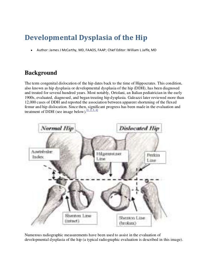 Developmental dysplasia of the hip