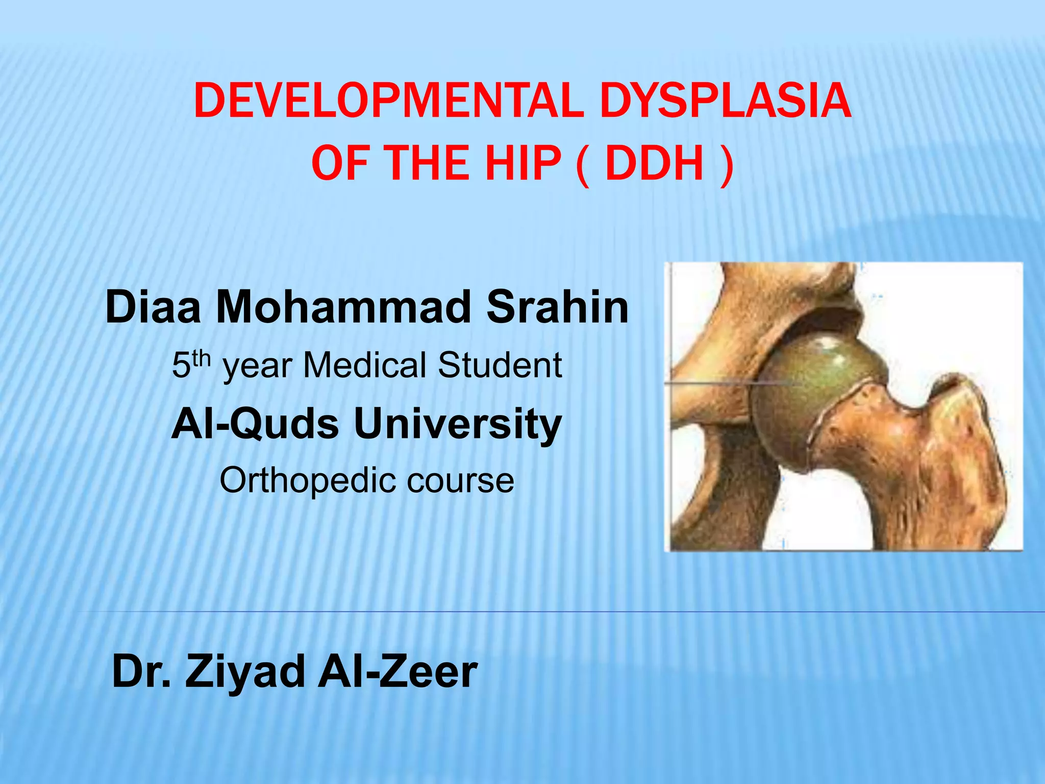 Developmental dysplasia of the hip | PPTX