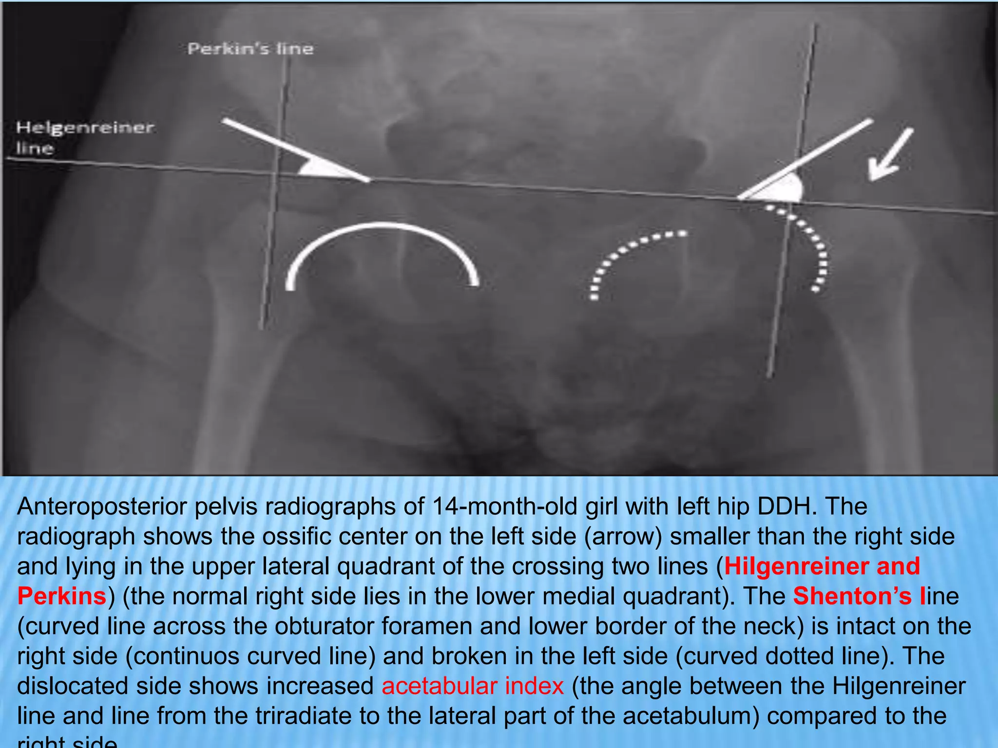 Developmental dysplasia of the hip | PPTX