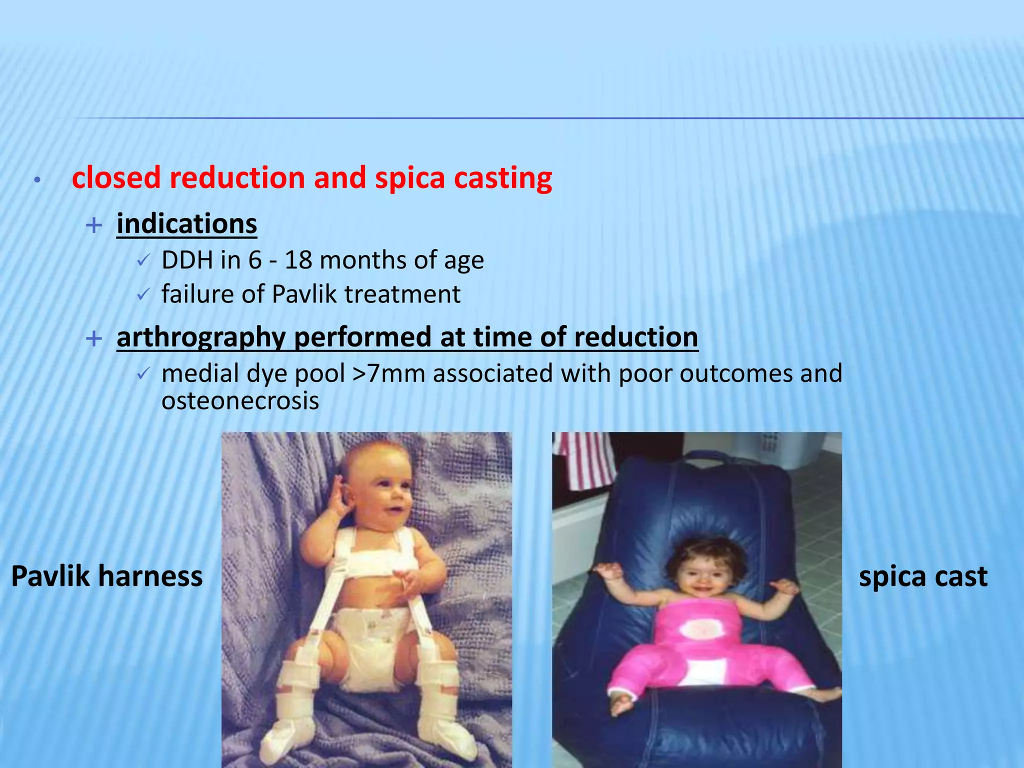 Developmental dysplasia of the hip | PPT