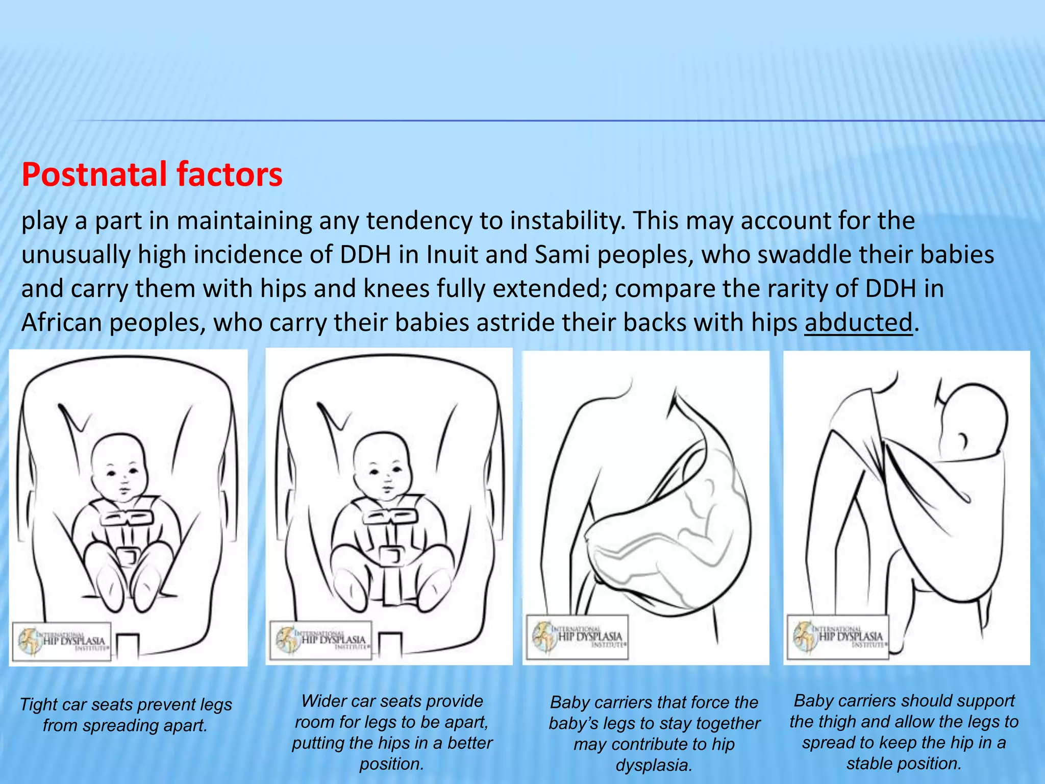 Developmental dysplasia of the hip | PPTX
