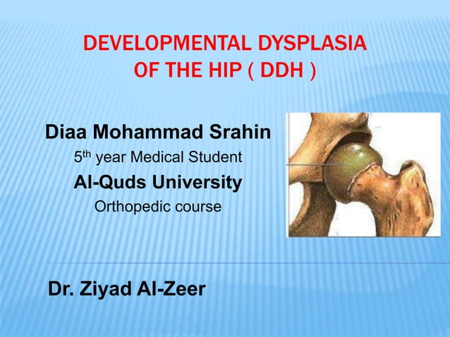 Developmental dysplasia of the hip | PPTX