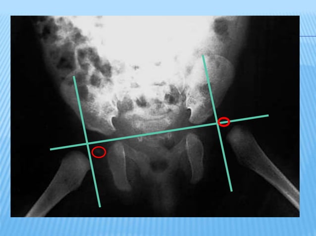 Developmental dysplasia of the hip | PPTX