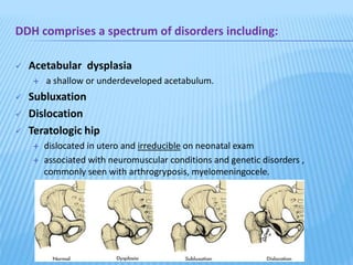 Developmental dysplasia of the hip | PPTX