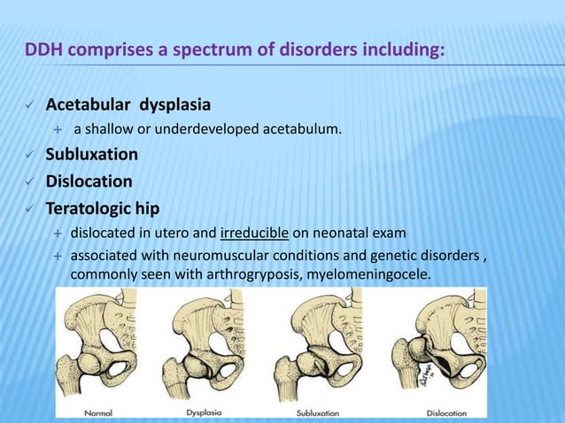 Developmental dysplasia of the hip | PPTX