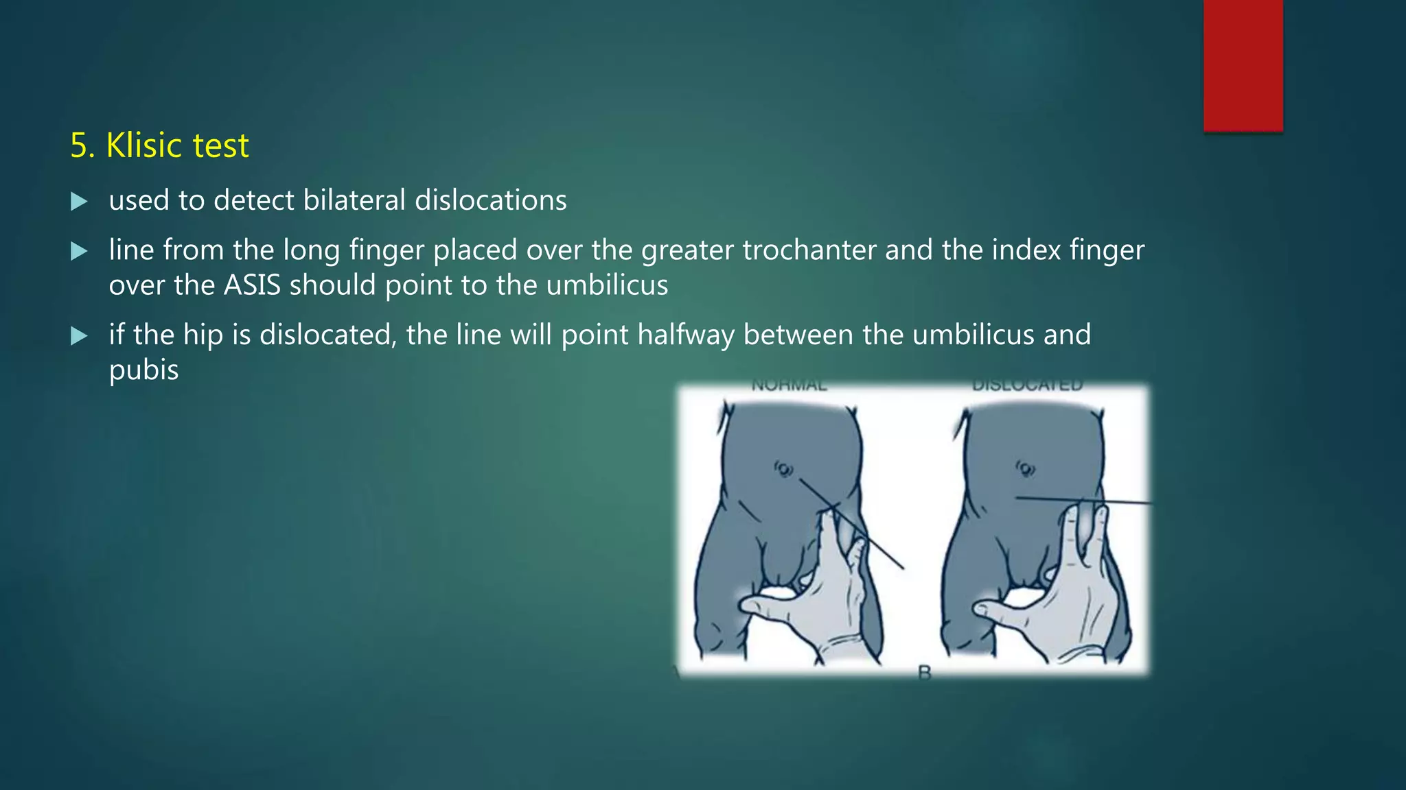 Developmental dysplasia of the hip | PPTX