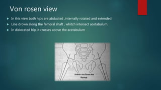 Developmental dysplasia of the hip | PPTX