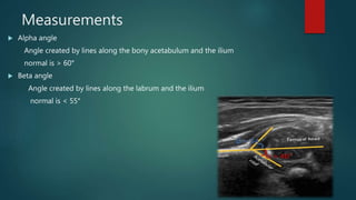 Developmental dysplasia of the hip | PPTX