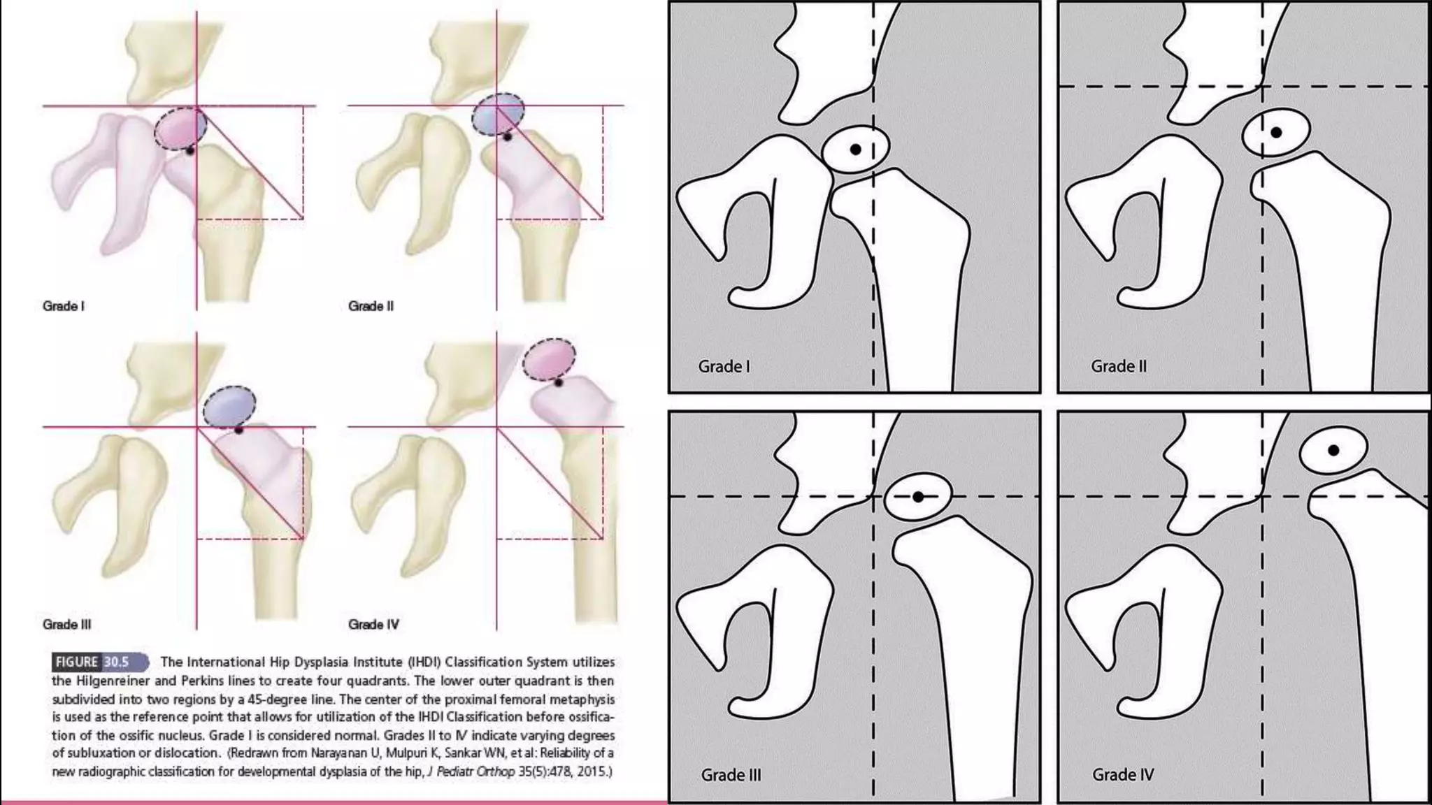Developmental dysplasia of the hip (DDH) | PPT