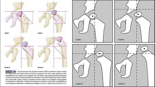 Developmental dysplasia of the hip (DDH) | PPT