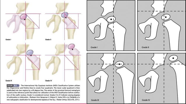 Developmental dysplasia of the hip (DDH) | PPT