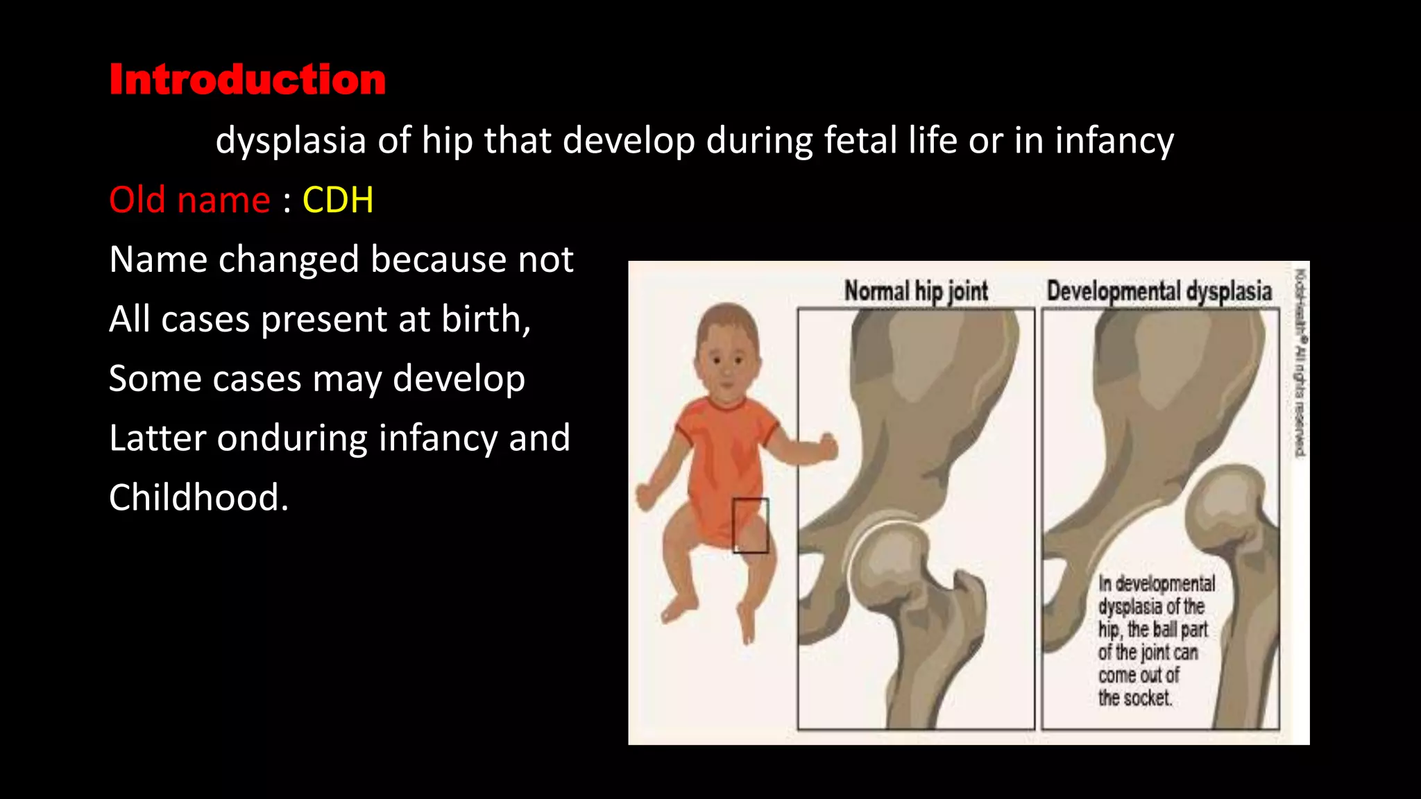 Developmental dysplasia of the hip (DDH) | PPTX