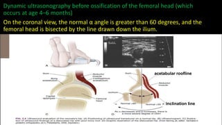 Developmental dysplasia of the hip (DDH) | PPT
