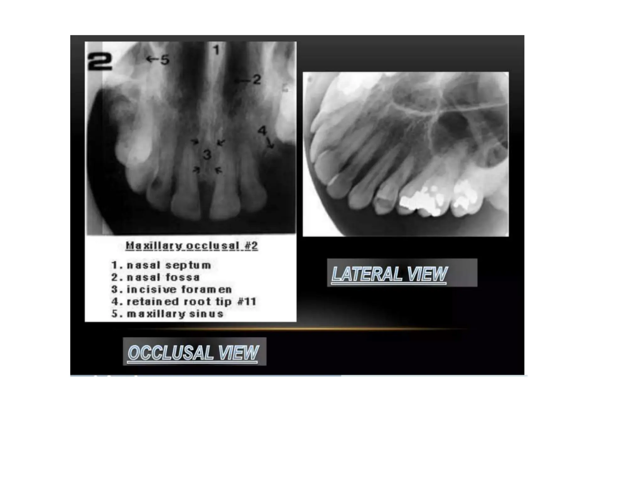 Development, Anatomy and Histology of Maxillary Sinus.pptx | Ear, Nose ...