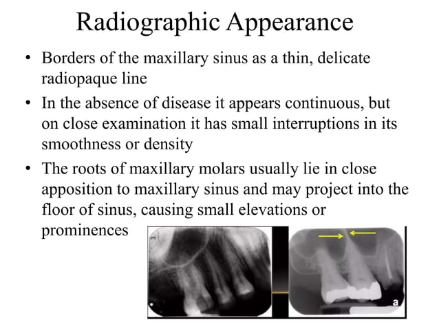 Development, Anatomy and Histology of Maxillary Sinus.pptx