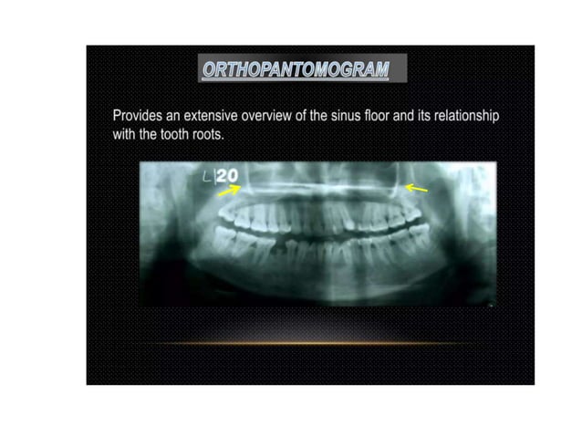 Development, Anatomy and Histology of Maxillary Sinus.pptx