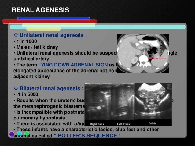 Unilateral Renal Agenesis Ultrasound Vs Pelvic Kidney
