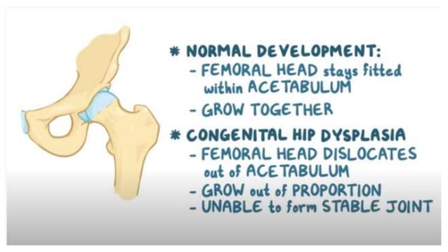 Development dysplasia hip | PPT