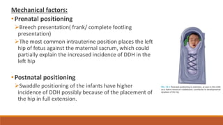 DEVELOPMENT DYSPLASIA OF THE HIP.pptx