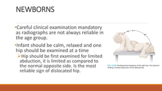 DEVELOPMENT DYSPLASIA OF THE HIP.pptx