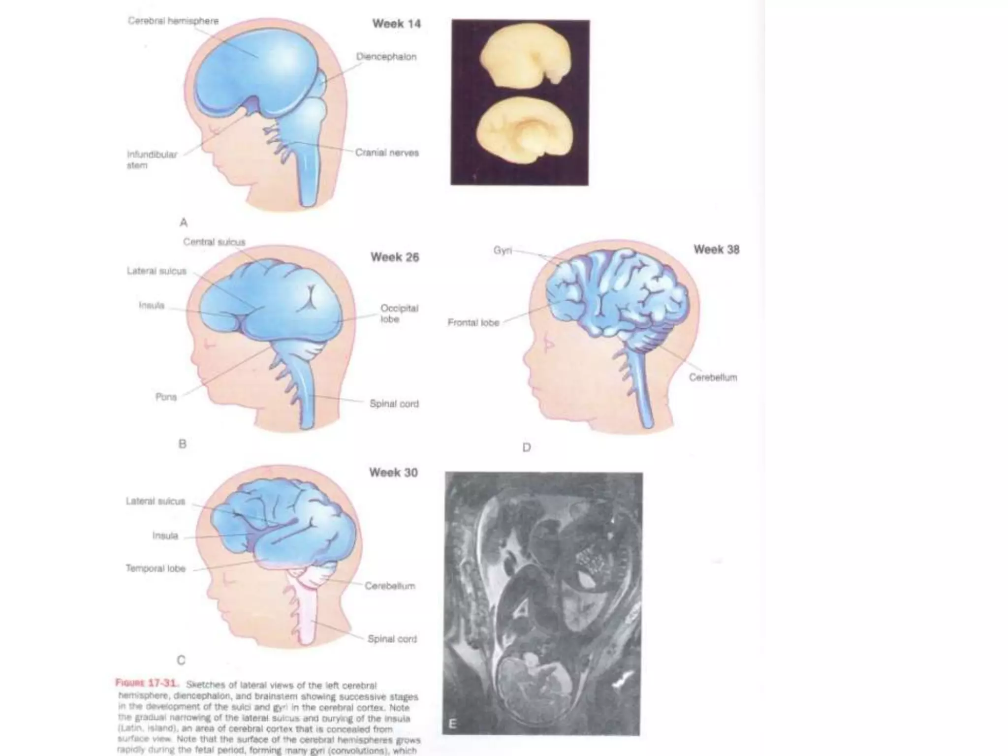 Development of cerebral hemispheres | PPTX