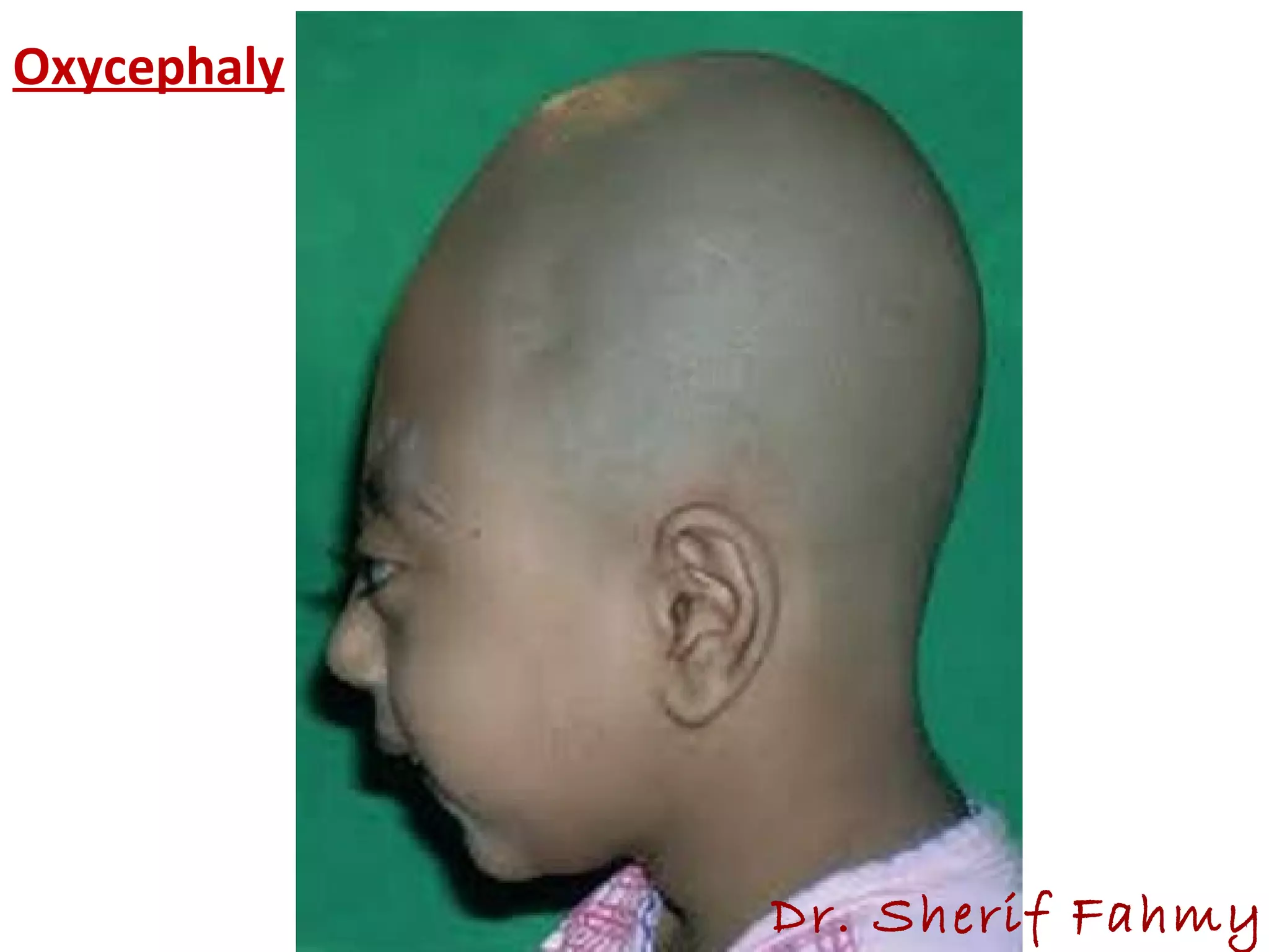 Development of Diaphragm, Skull, Vertebrae & Limbs (Special Embryology ...
