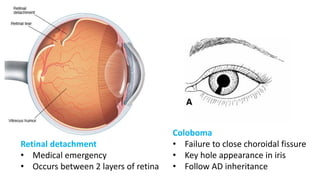 Development of eye. | PDF