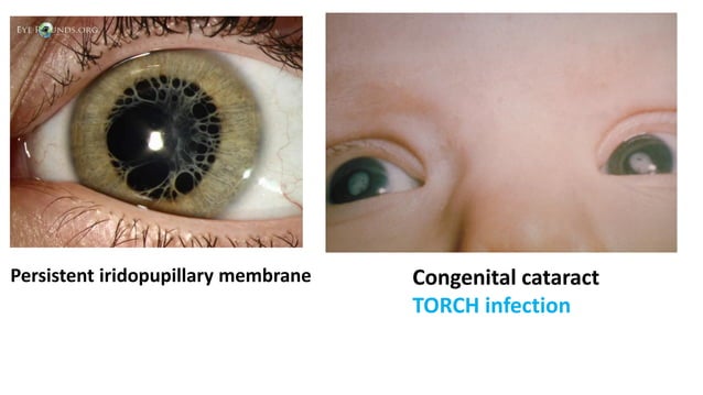 Development of eye.