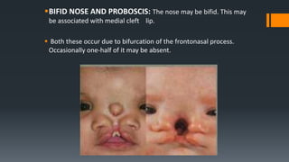 Development of face and palate | PPTX