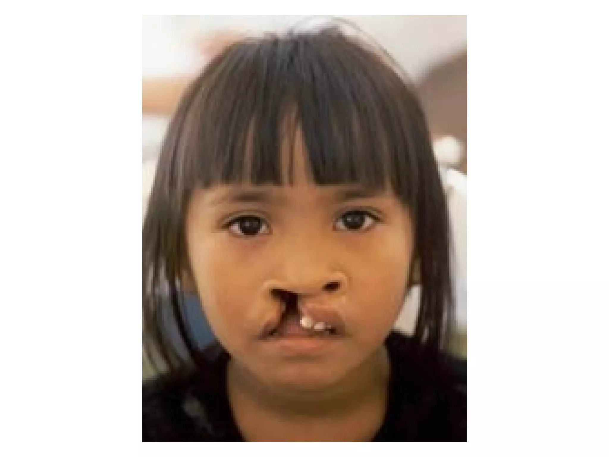Development of Face, Nose and Palate (Special Embryology) | PPS