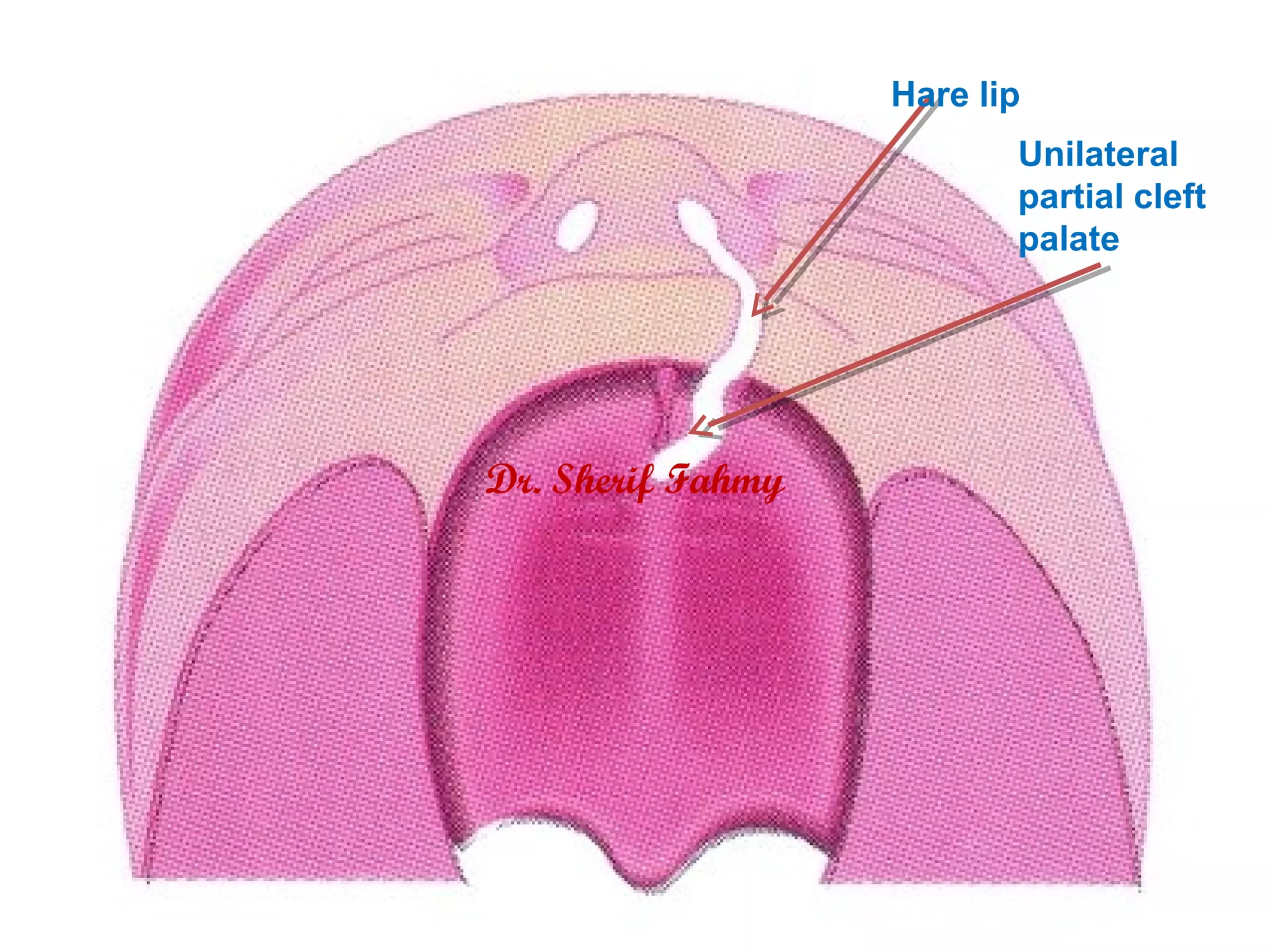 Development of Face, Nose and Palate (Special Embryology) | PPS