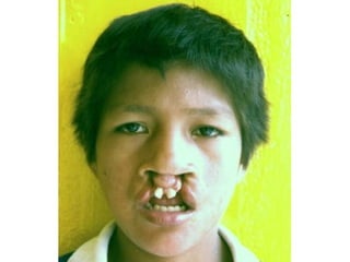 Development of Face, Nose and Palate (Special Embryology) | PPS