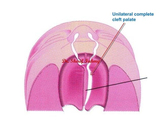 Development of Face, Nose and Palate (Special Embryology) | PPS | Ear ...