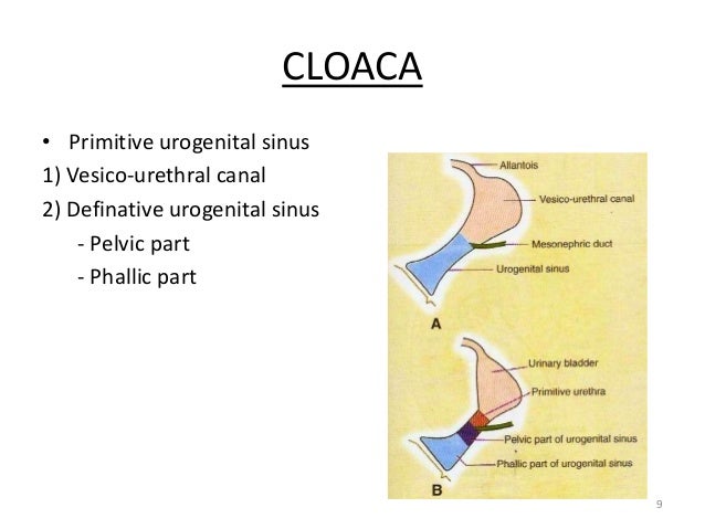 Urogenital Sinus Anomaly
