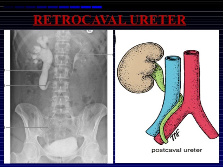 Development of kidney and ureter 05.01.12